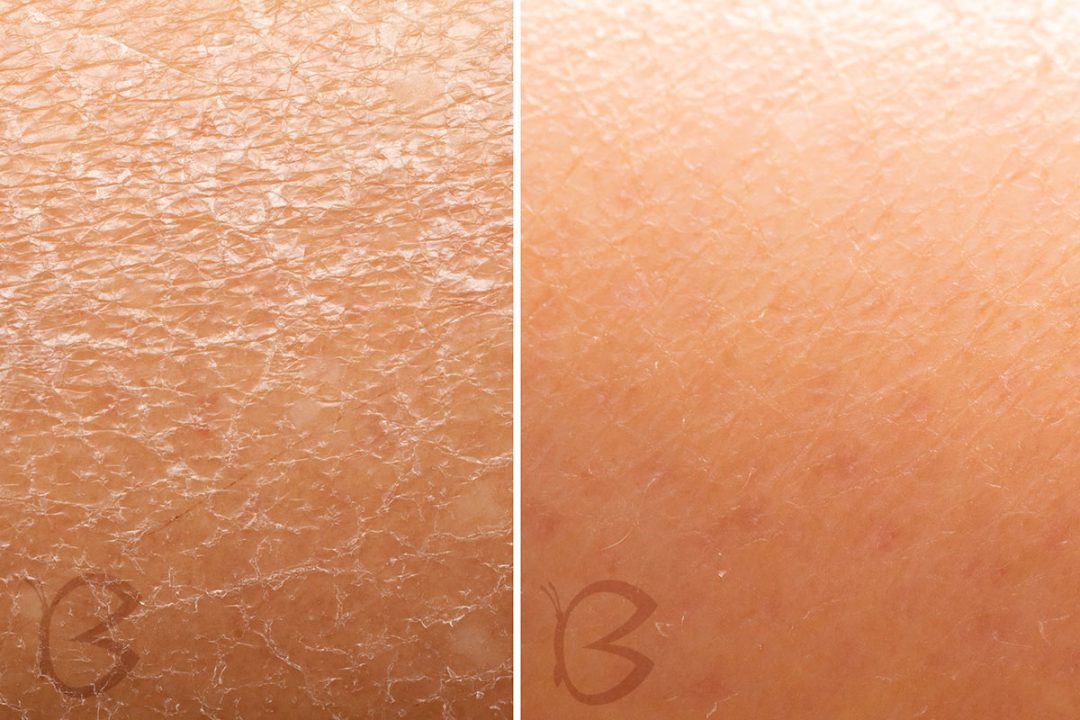Mikrodermabrazja diamentowa B-Derma Basic - BEAUTIFLY