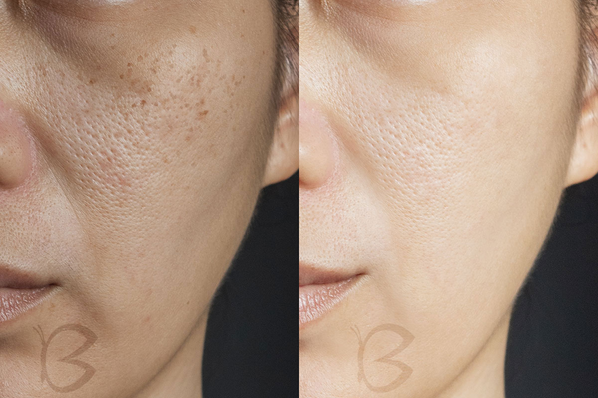 Mikrodermabrazja diamentowa B-Derma Basic - BEAUTIFLY